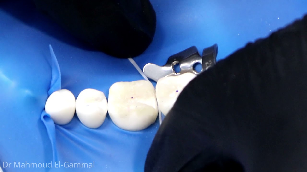 09- Floss Inversion of the Rubber Dam - YouTube