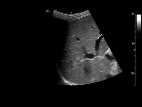 Point-of-care ultrasound diagnosis of pneumoperitoneum - YouTube