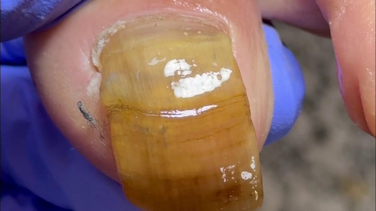 Hard Thick Nails, Professional Pedicure Saved It【Doctor Liu Pedicure ...