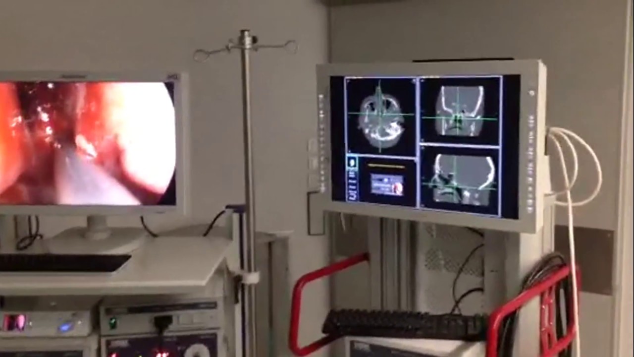 Live surgery room, monitors and navigation systems - YouTube