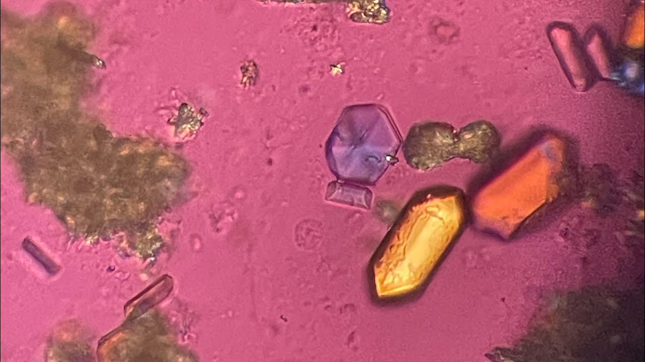 Urinalysis: Triple phosphate crystals - YouTube