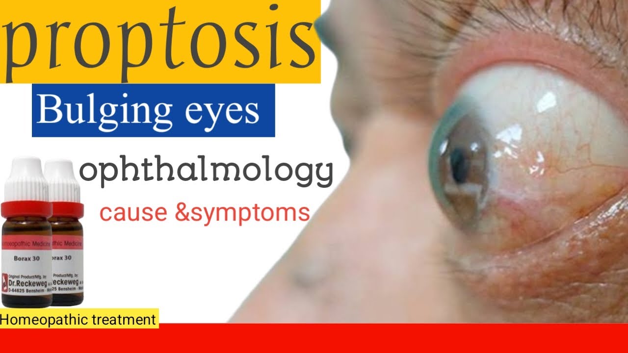 Bulging of eyes, ophthalmology (proptosis) causes & symptoms and ...
