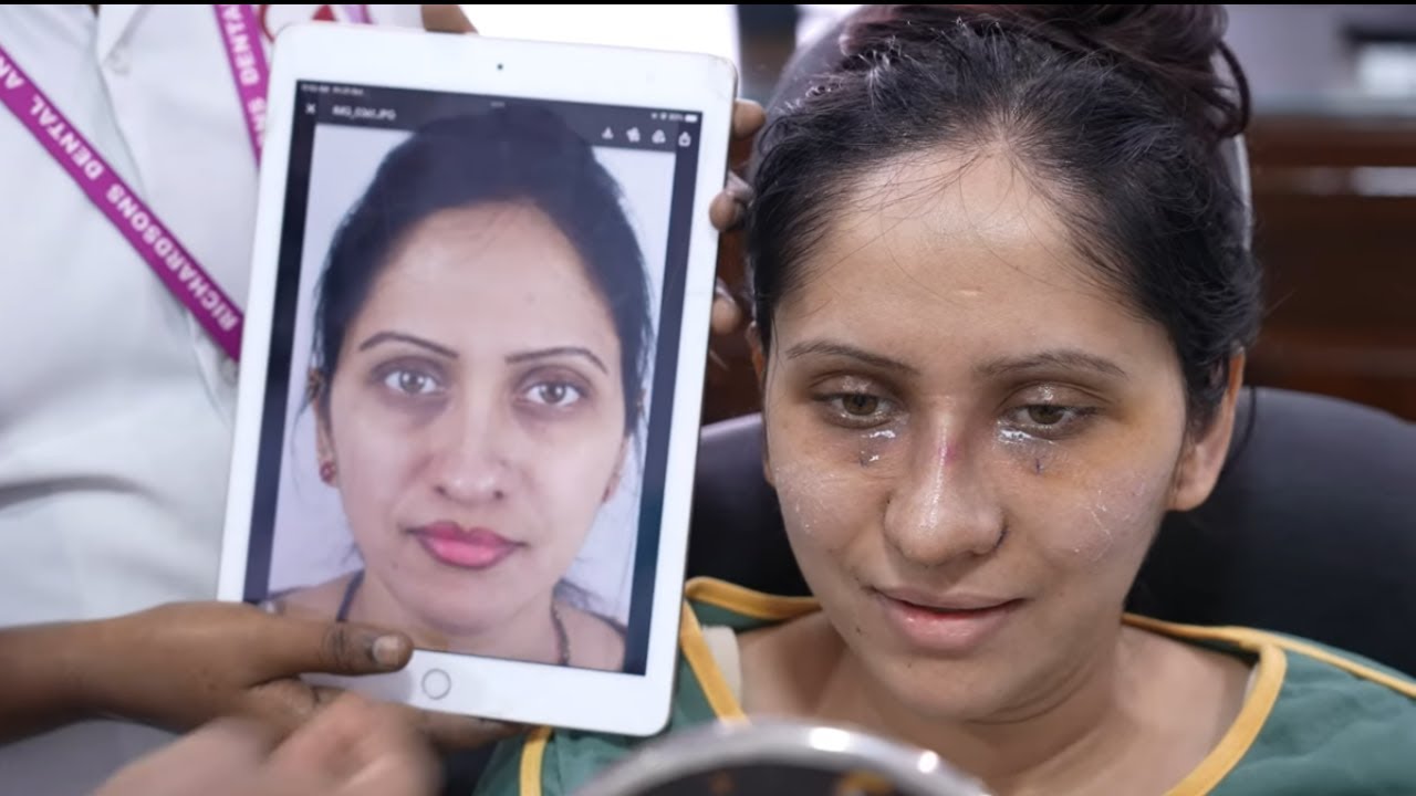 9th Day Results of Cosmetic Nose Job | Nasal Splint Removal Video - YouTube