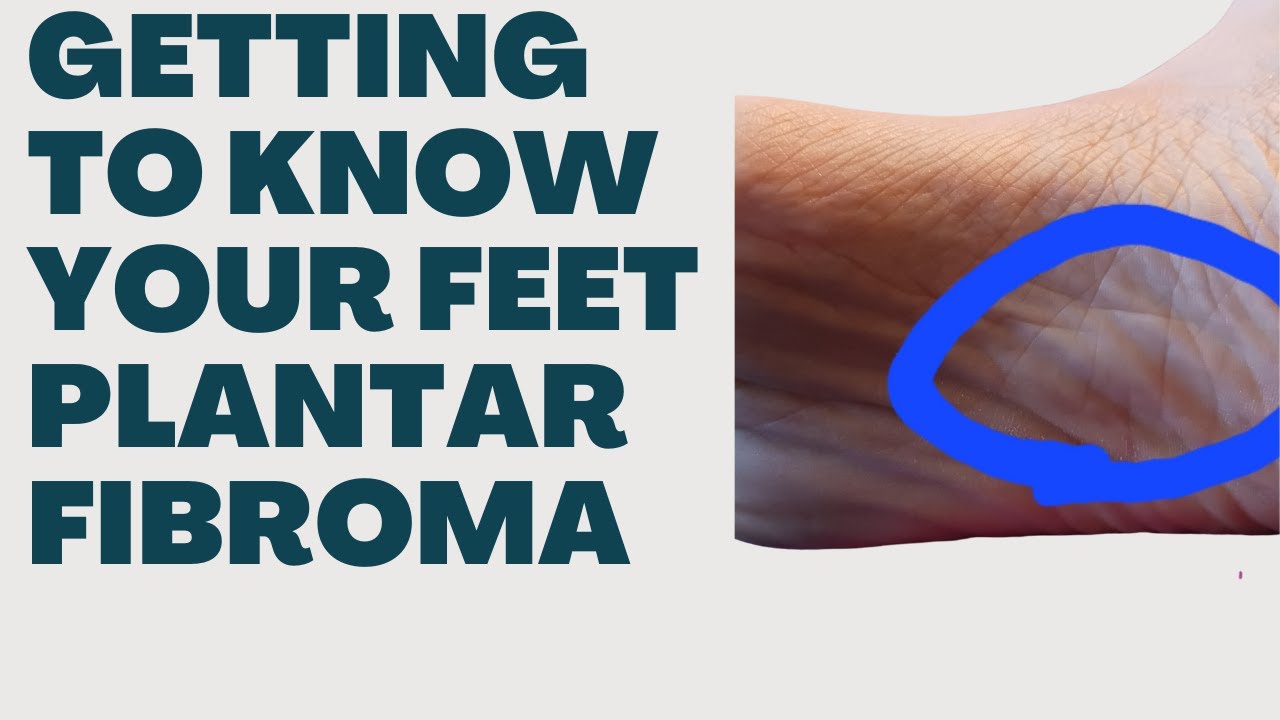 Get in there and check them feet! How I found a fibroma in my foot ...
