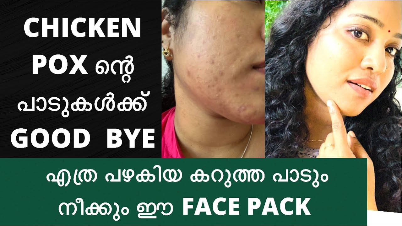 Amazing DIY Remedies for Chicken Pox Marks | Natural Tip for removing ...