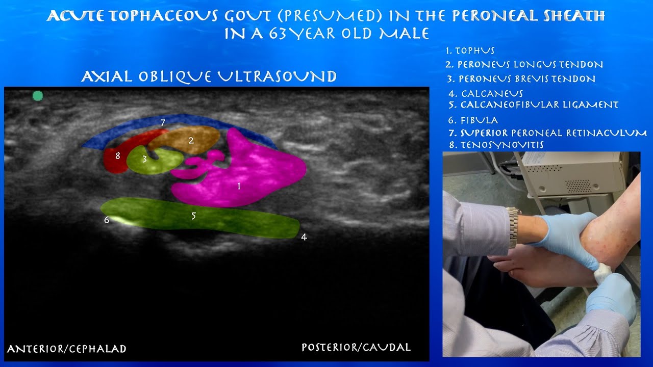 Ultrasound of Presumed Gouty Tophus in the Peroneal Sheath in a 63 Year ...