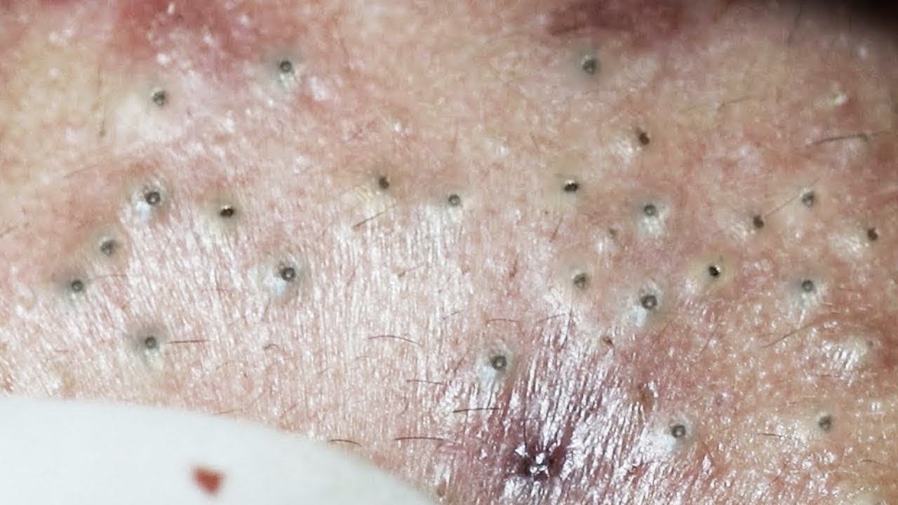Big Cystic Acne Blackheads Extraction Blackheads & Milia, Whiteheads ...
