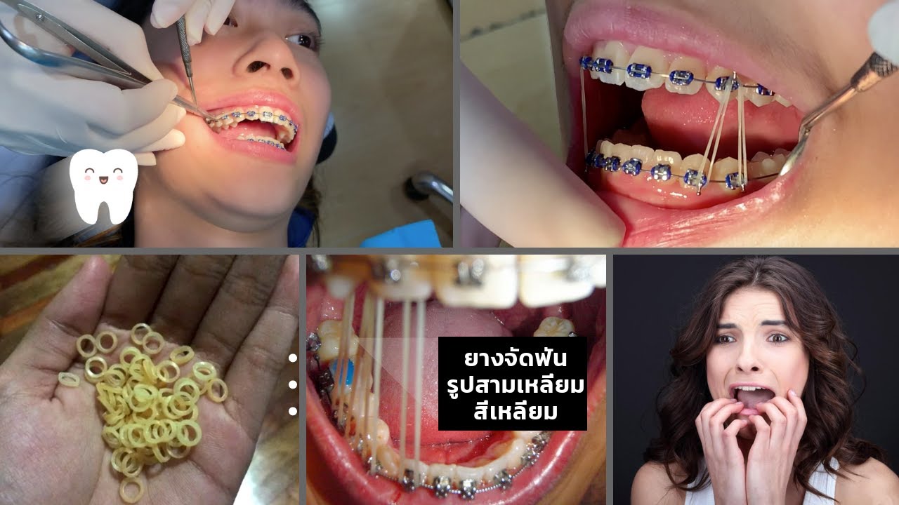 วิธีเกี่ยวยางดึงฟันเป็นรูปสามเหลี่ยมและสี่เหลี่ยม (Triangle & Box ...