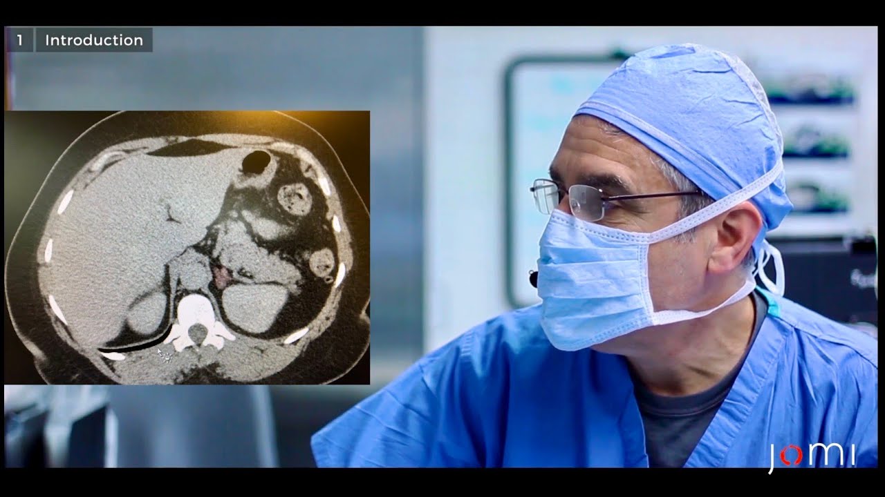 Laparoscopic (Left) Adrenalectomy (Links to Full Procedure) - YouTube