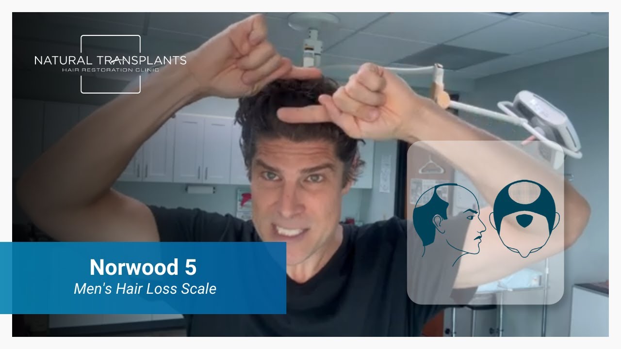 Norwood 5 Male Pattern Baldness: Men’s Hair Loss Scale Explained - YouTube