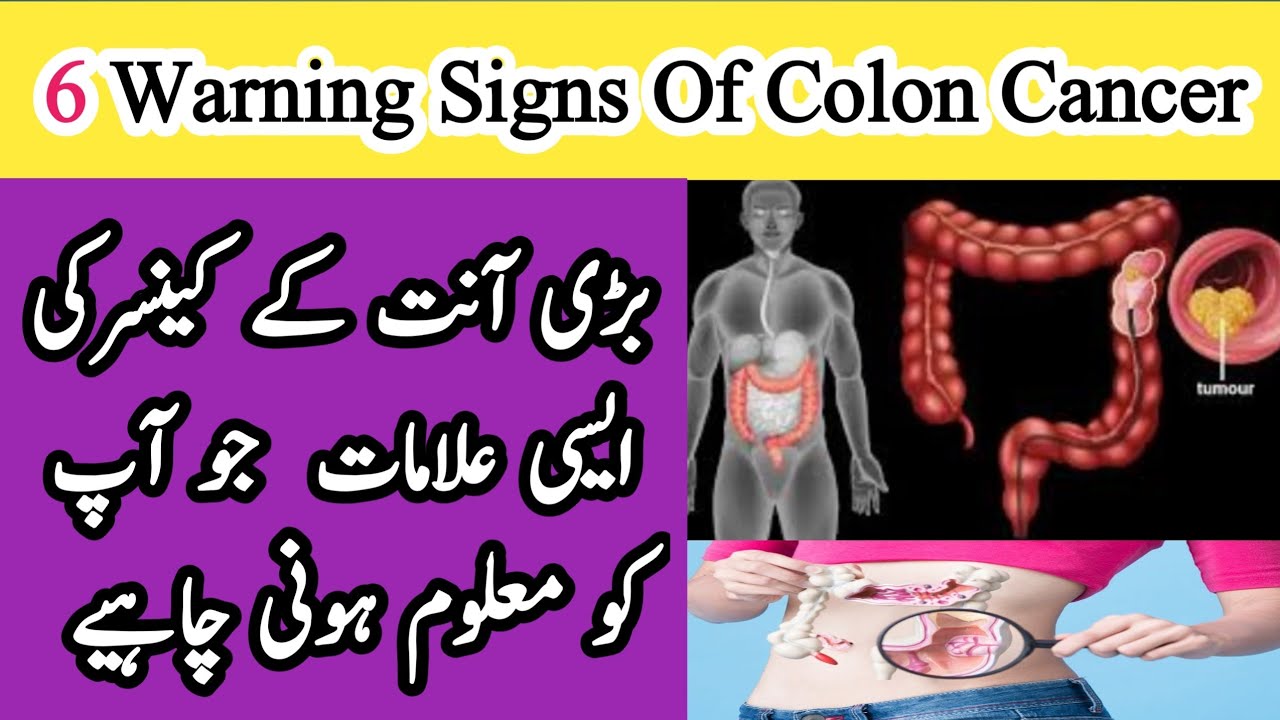 Bari Aant ka Cancer ki Alamat - 6 Warning Signs Of Colon Cancer ...
