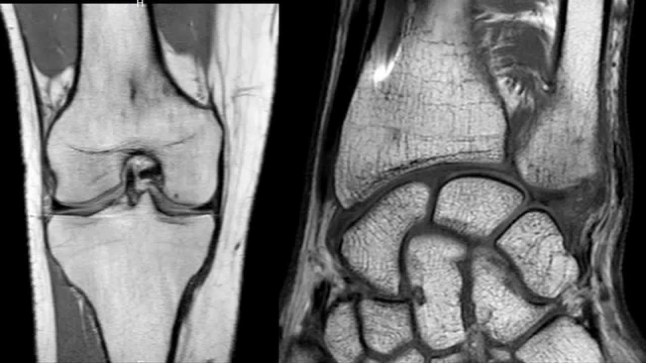 MRI: Imaging of the Joints - YouTube