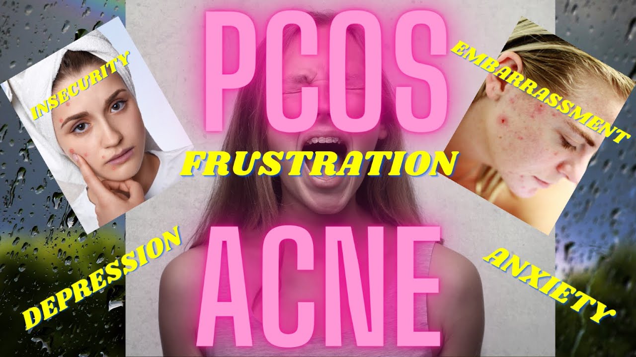 PCOS Related ACNE #Acne #Spots #acnecauses #acnescars #acnetreatment # ...