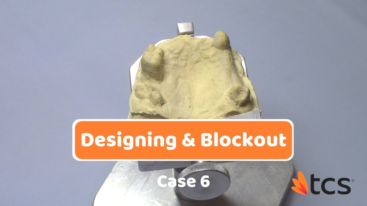 Designing & Blockout Case 6 - Great Story, Happy Patient - YouTube