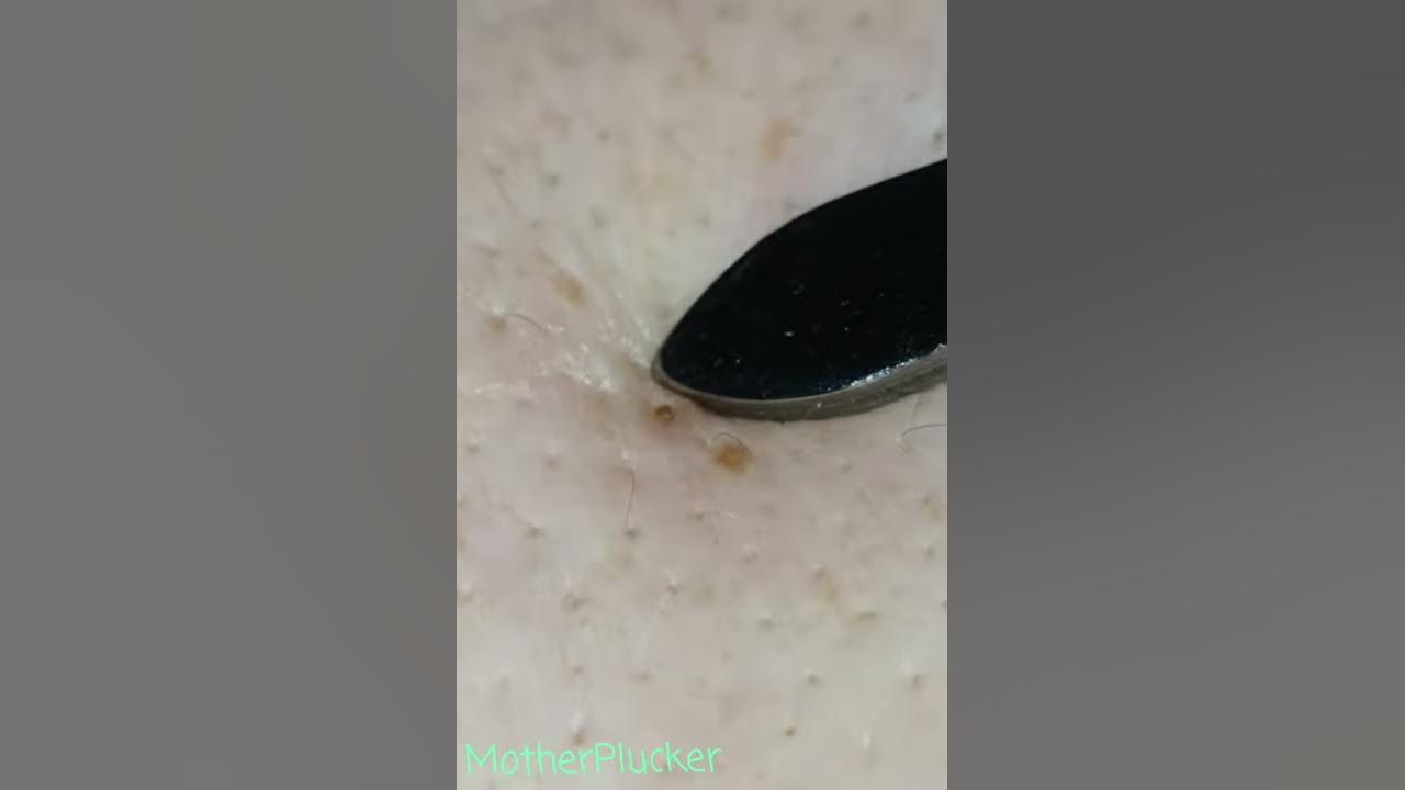 Satisfying Blackhead Extraction Youtube