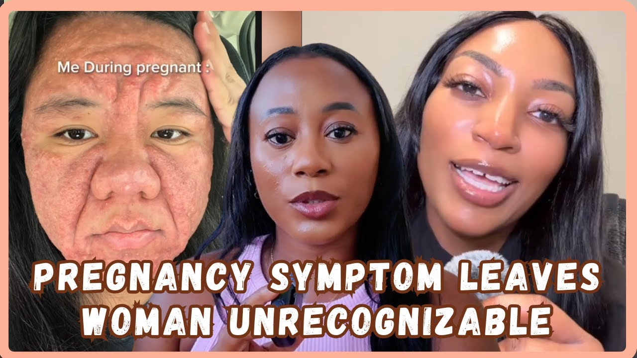 Allergic To Her Own Pregnancy? Woman's Face Transforms After Rare ...