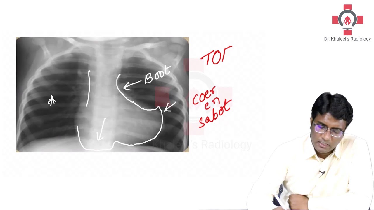Tetralogy Of Fallot X Ray