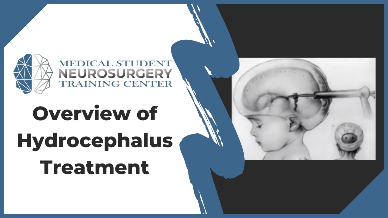 How To Treat Hydrocephalus – Hydrocephalus Treatment – NOSXAT