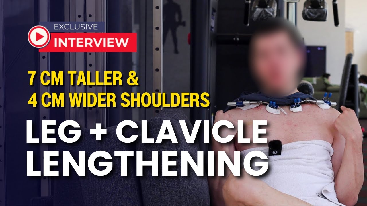 TALLER & BOLDER | Leg and Clavicle Lengthening: A Life-Changing ...