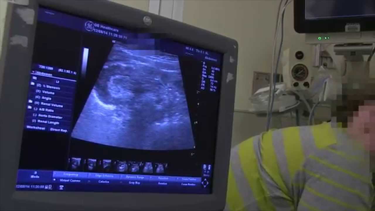 Intussusception Diagnosis and Treatment - YouTube