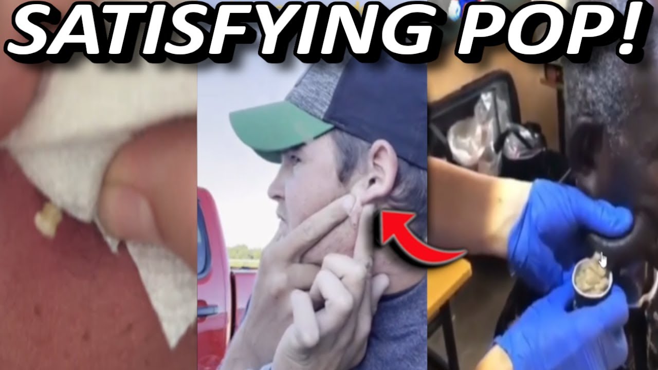 Mind Blowing TikTok Pimple and Cyst Pops! - YouTube