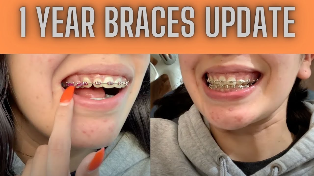 1 YEAR 9 MONTHS braces update: comparison + extractions + rubber bands ...