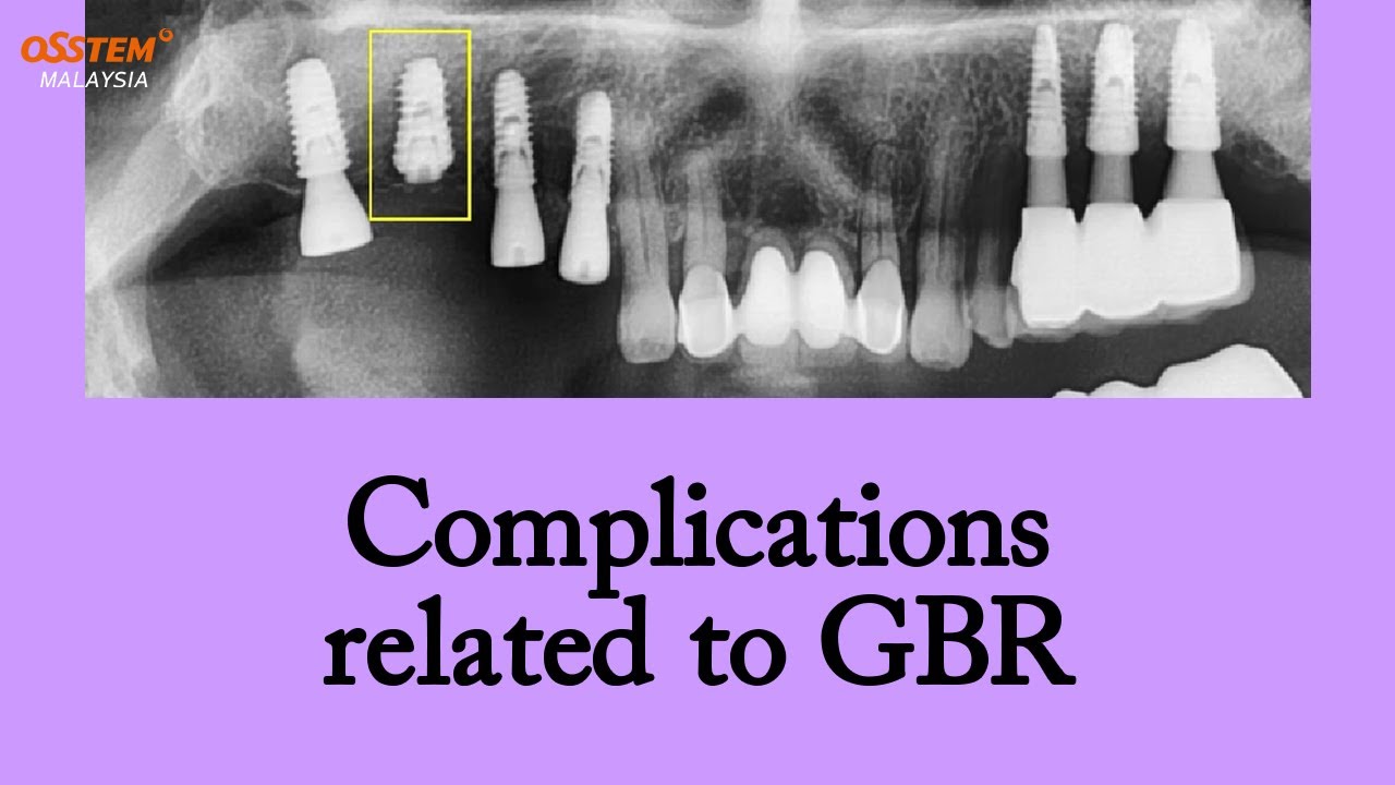 Surgery Series 3 (9) : Complications related to GBR - YouTube
