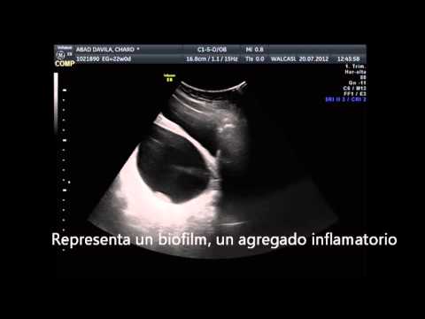 sludge o sedimento intraamniótico - YouTube