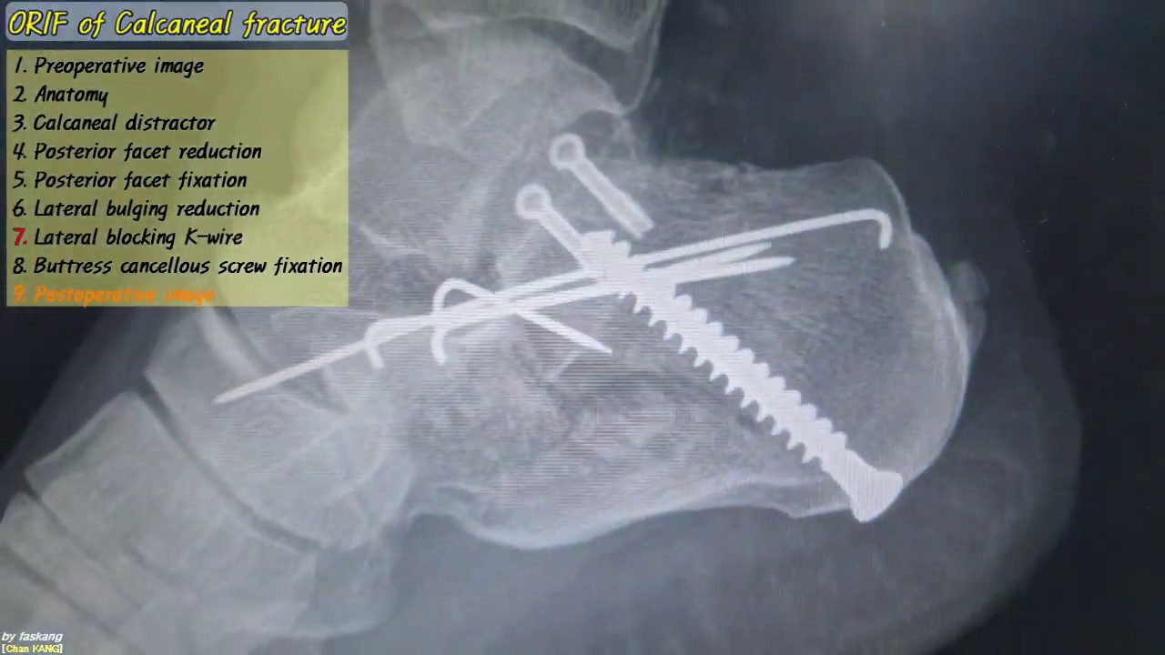 301.(의사용.Surgery.part3. 6-9) 'Lateral blocking K-wire' on Calcaneal fx ...