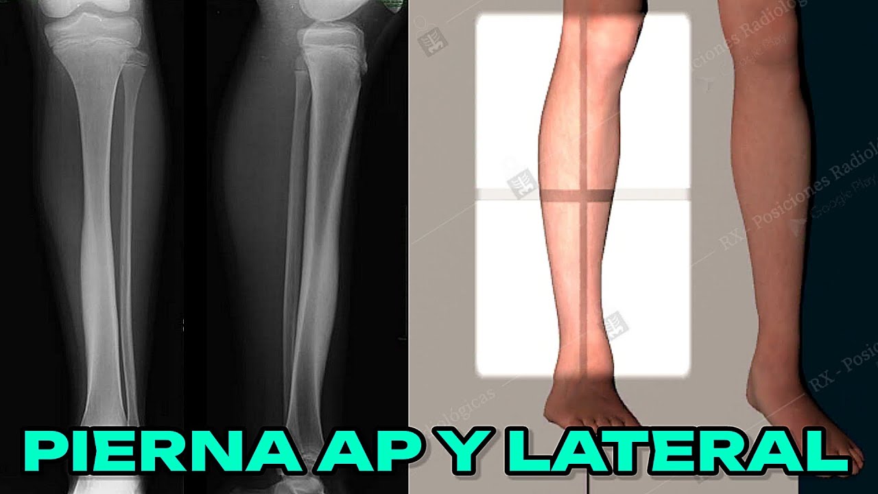 RADIOGRAFÍA DE PIERNA AP Y LATERAL (MANUAL DE BOLSILLO) #17 - YouTube