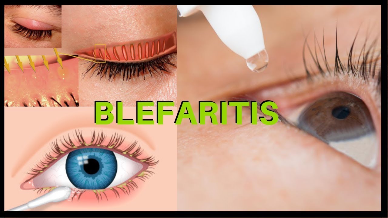 👁¿Qué es la BLEFARITIS? soluciones - YouTube