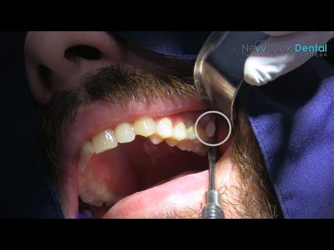 ¿Dientes de más en la boca? Conoce los dientes SUPERNUMERARIOS 🦷🦷🦷 ¿Hay ...