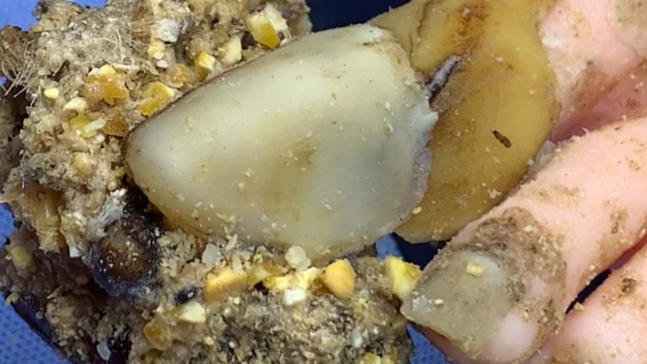 Surprising ingrown position! the ingrown nails are curled like horns ...