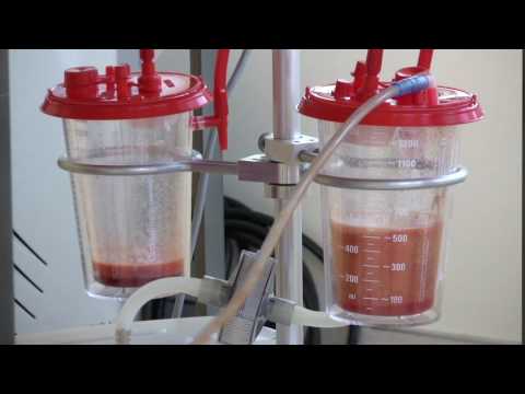 The Liposuction Procedure - YouTube