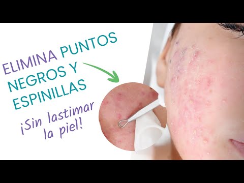 Aprende CÓMO QUITAR los puntos negros y espinillas | De forma FÁCIL y SIN DAÑAR LA PIEL
