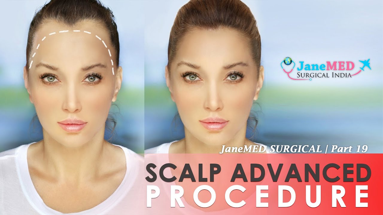 Scalp Advanced Procedure | JaneMED SURGICAL | Part 19 - YouTube