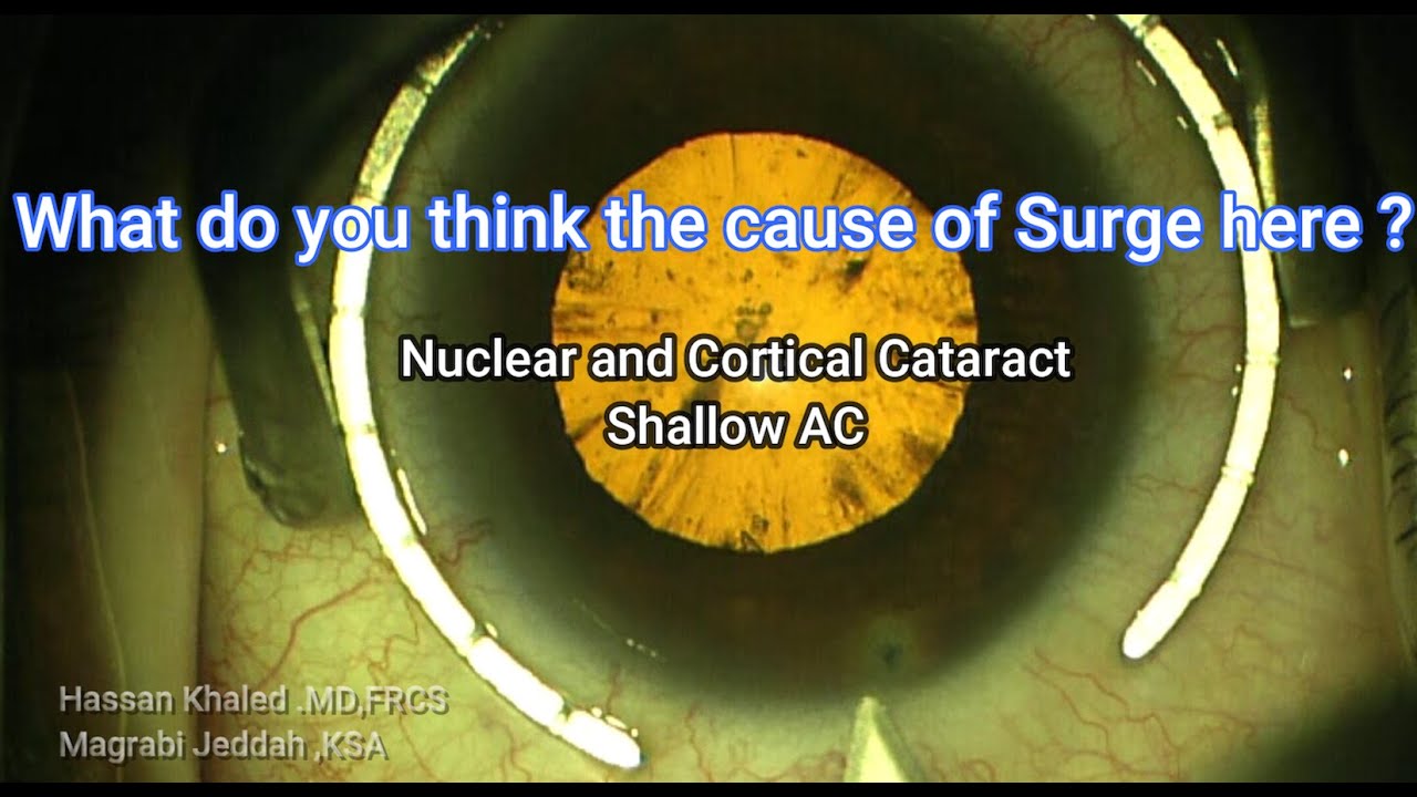 SURGE During Phacoemulsification Of Cataract With Shallow AC. - YouTube
