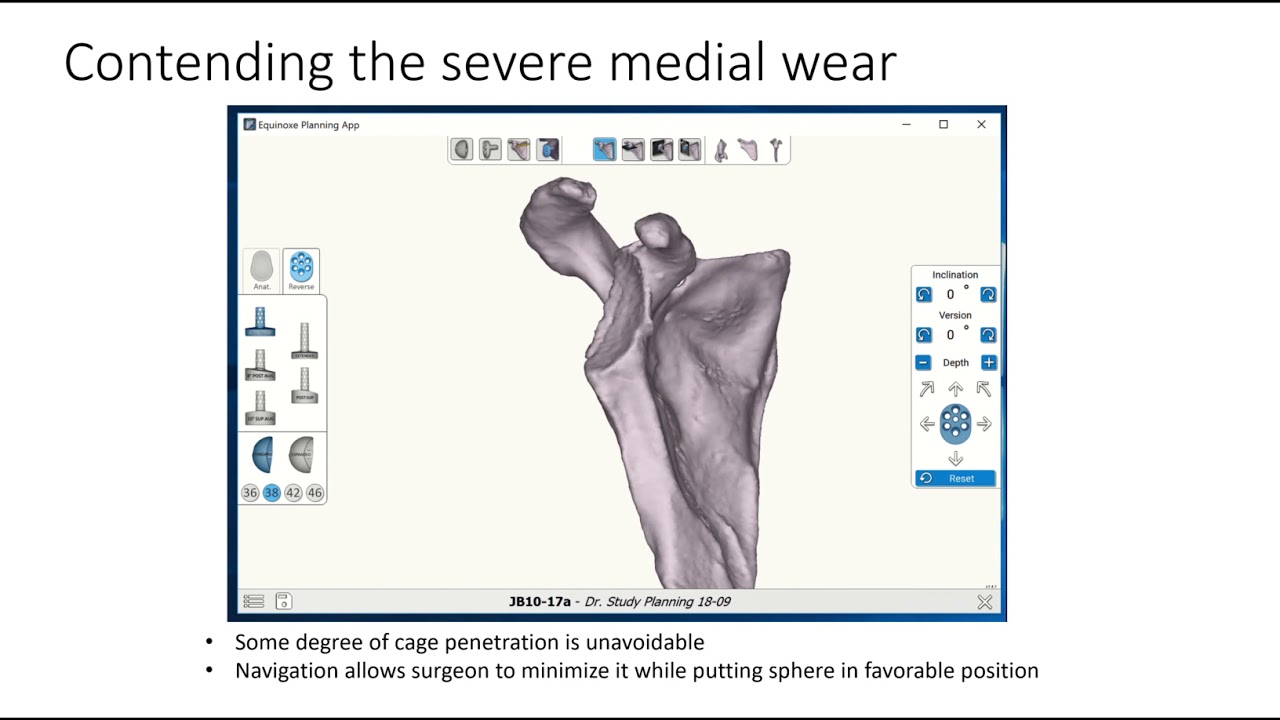 Exactech GPS Preoperative Planning Examples - YouTube