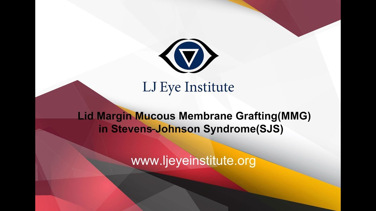Lid margin mucous membrane grafting(MMG) in Stevens - Johnson Syndrome ...