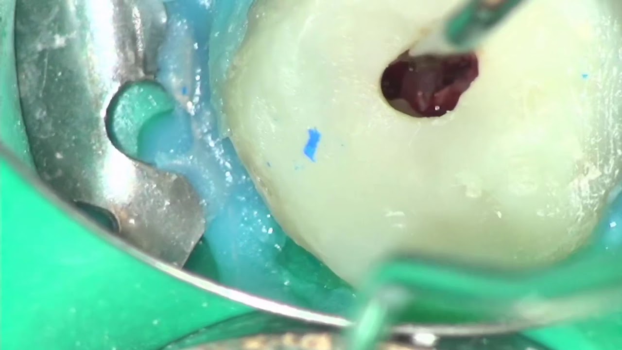 This tooth used to have a lot of nerve! - YouTube