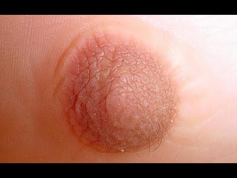 Göğüs Ucu (AREOLA) Estetiği  II Dr. Fatih Dağdelen'le Sağlık