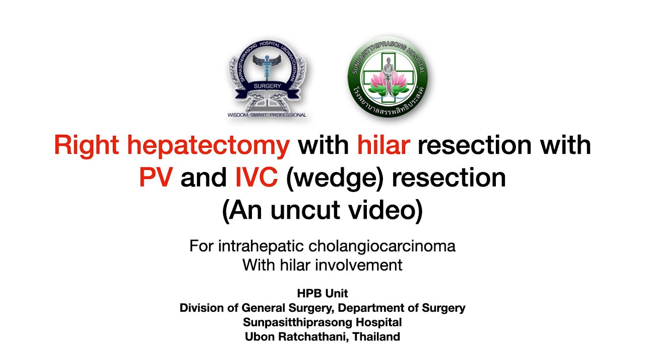 Right hepatectomy with hilar resection with PV and IVC resection for ...
