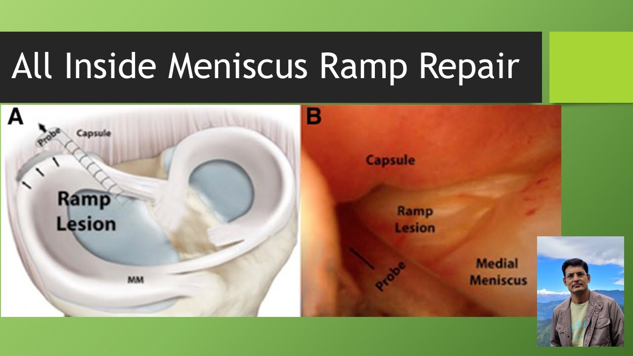 Ramp repair with all inside meniscus repair device - YouTube