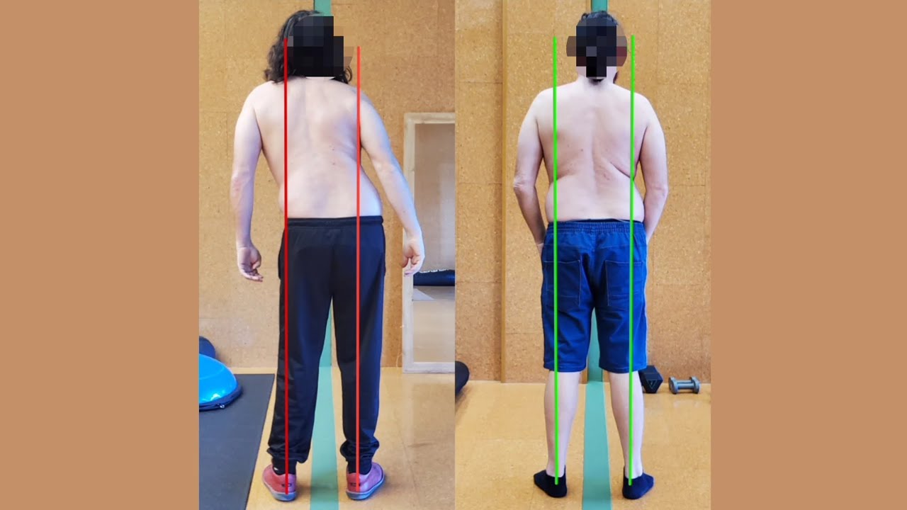 Progresos de Postura de Cifosis y Escoliosis con hernias y pinzamientos ...