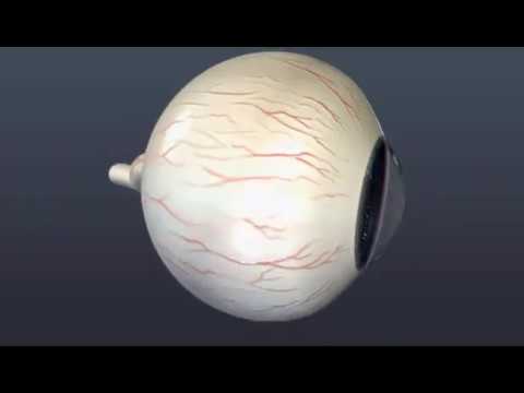 Cataract Surgery Animation - YouTube