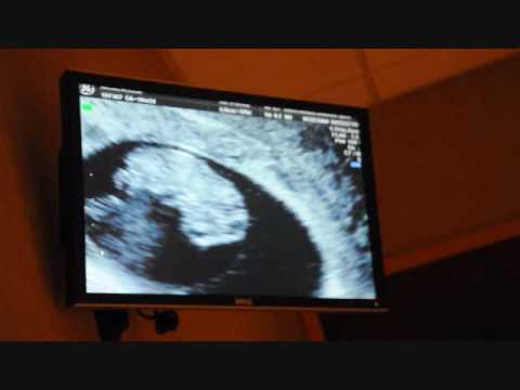 9 weeks 3 days Ultrasound - YouTube
