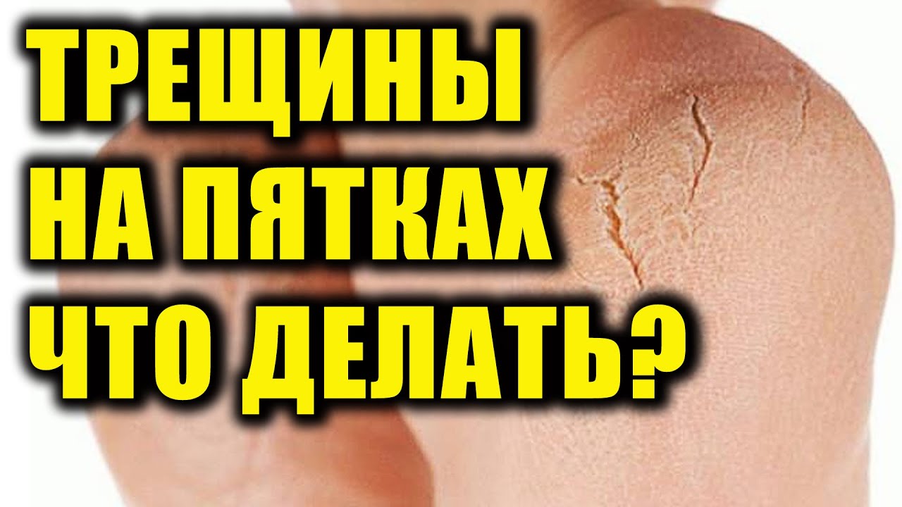 Как избавиться от трещин на пятках - YouTube