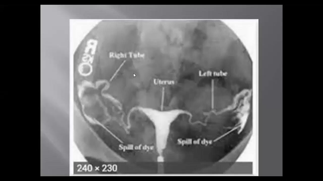 How to read and understand Hysterosalpingography - YouTube