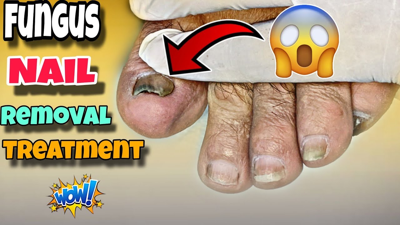Pedicure ASMR Treatment of Nail fungus removal | Tough Condition ...