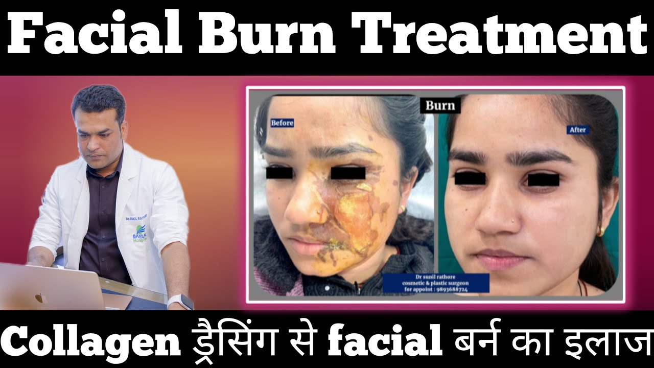 Facial Burn - आग या गर्म चीजों से जलने पर collagen ड्रेसिंग द्वारा कैसे ...
